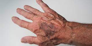 O que você precisa saber sobre a púrpura senil (e dez dicas de cuidados ...